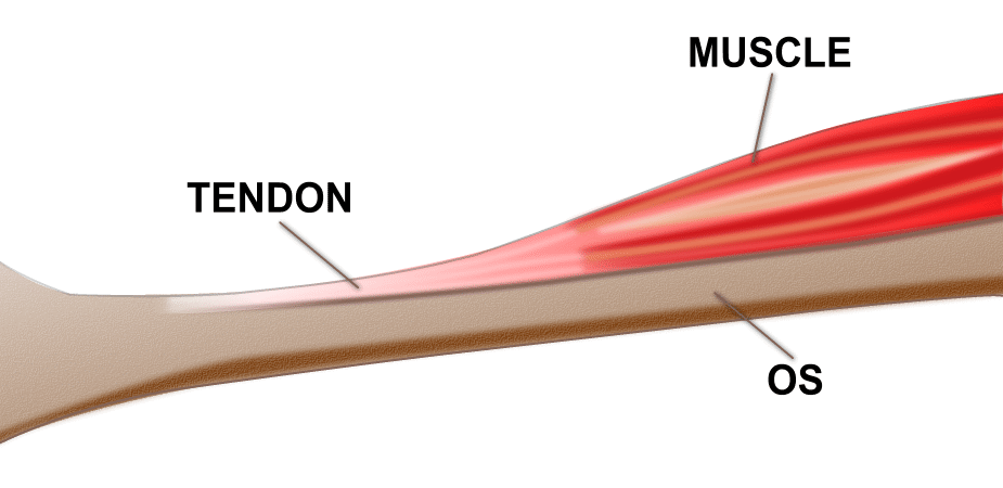 La tendinite par Jem Consulting Alsace